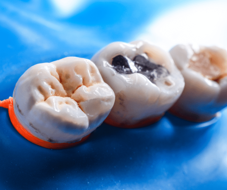Tipos de empastes dentales: ¿cuál elegir? | Parc Bosc Dental